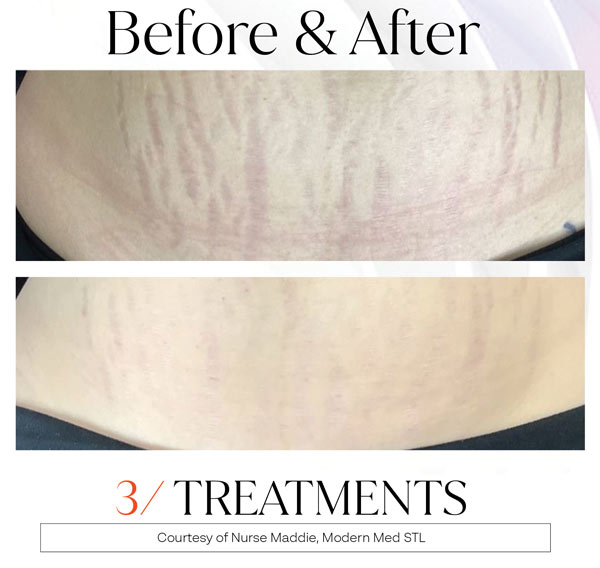RF Microneedling Clinic Toronto | Miracle Beauty Aesthetic Clinic